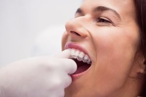 How to Remove Stains from Invisalign Attachments : 6 Effective Tips ...